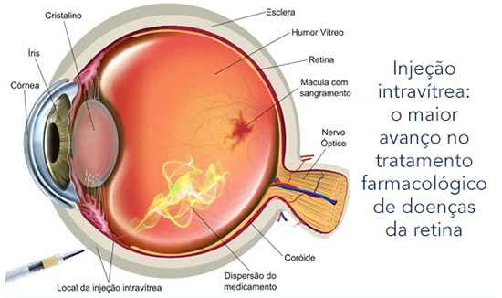 Tratamento da DMRI - CRV Oftalmologia - Centro de Referência da Visão ...
