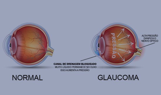 Tratamento do Glaucoma - CRV Oftalmologia - Centro de Referência da Visão em Vitória-ES